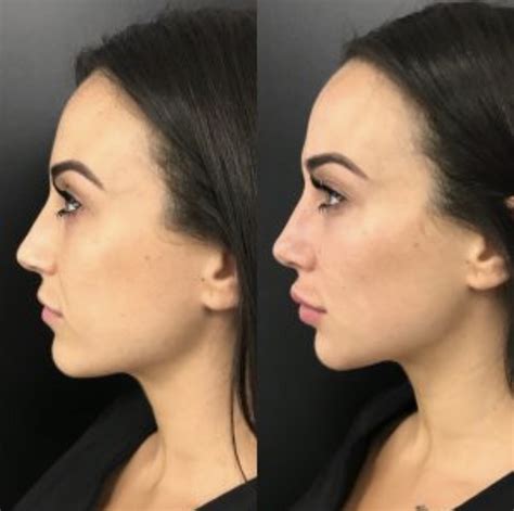 Cheek Augmentation Iconic Beautique