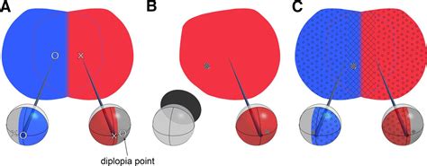 Interocular Suppression In Primary Visual Cortex In Strabismus