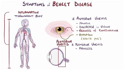 Behcet S Disease Video Anatomy Definition Function 51 OFF