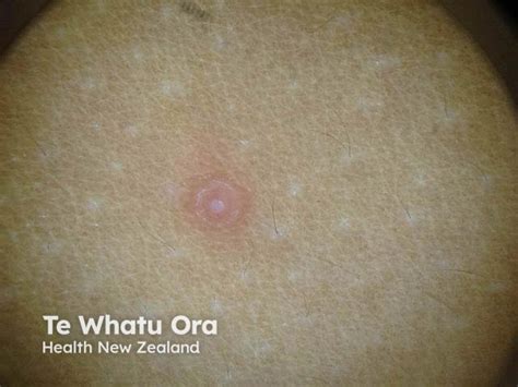 Molluscum Contagiosum Image