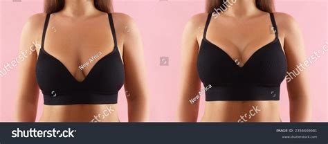 6338 Imágenes De Breast Lift And Lift Imágenes Fotos Y Vectores De