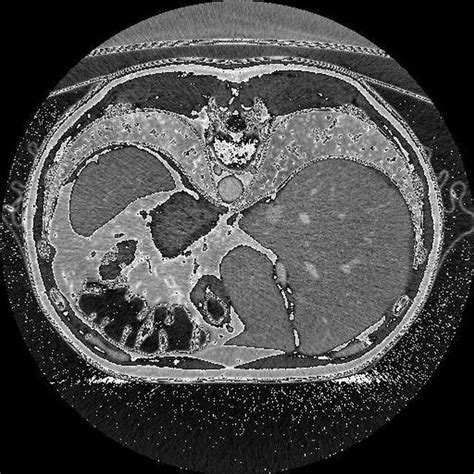 lung cancer segmentation instance segmentation dataset and pre trained
