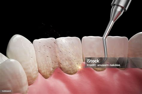 환자의 치아를 청소하는 동안 치과 도구를 닫습니다 치과 치료를 받는 치아의 3d 그림 치석에 대한 스톡 사진 및 기타 이미지 치석 치은염 디지털 생성 이미지 Istock