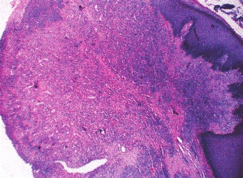 Photomicrograph Showing Irregular Stratified Squamous Hyperkeratinized