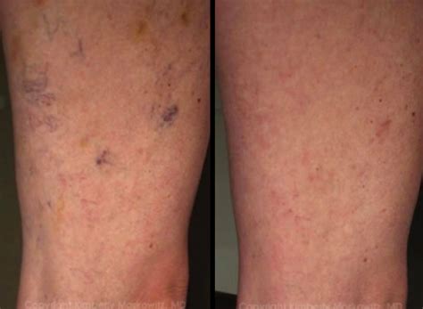 This Patient Had Almost Cosmetic Vein And Laser Center