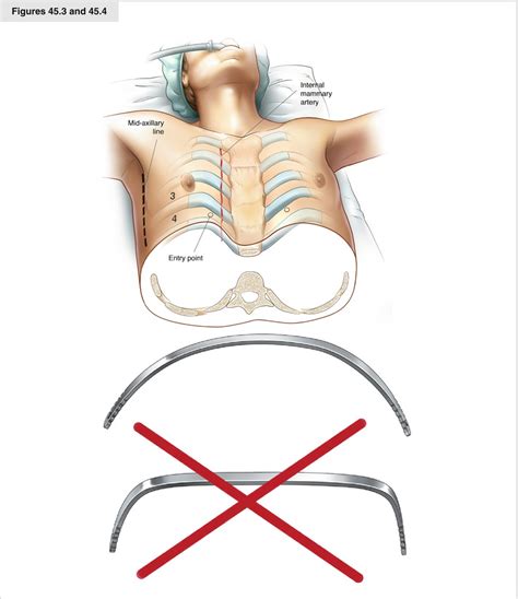 Nuss Procedure For Pectus Excavatum Thoracic Key