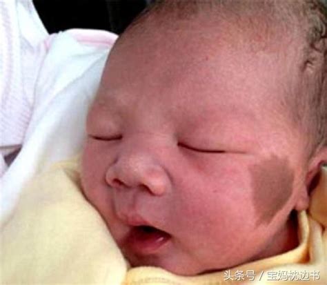 胎記不好看，長臉上更可怕，想要寶寶不長胎記，孕媽記住這幾點！ 每日頭條