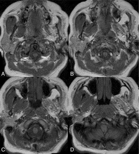 Axial T1wi Through The Skull Base Demonstrating Left Trigeminal Nerve