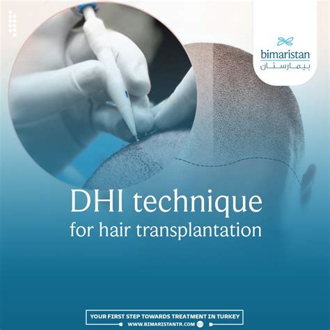 Dhi Hair Transplantation And Its Cost In Turkey بيمارستان