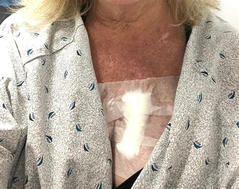 My Skin Cancer Surgery In Pictures
