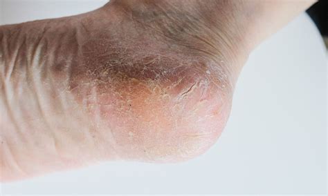 Diabetes And Dry Skin Merino Skincare