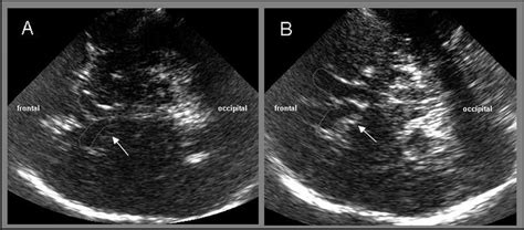 Sonographic Evaluation Of The Caudate Nucleus In Axial Examination