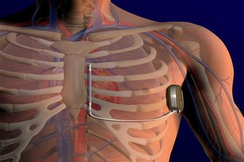 Qual è La Differenza Tra Pacemaker E Defibrillatore Sottocutaneo