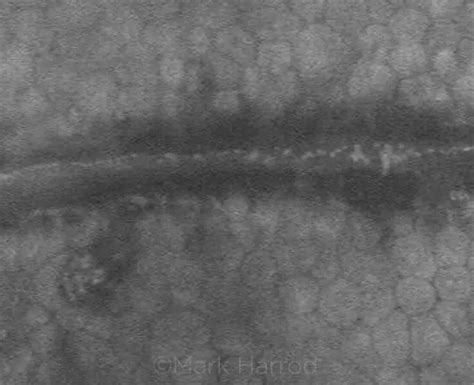 Posterior Polymorphous Corneal Dystrophy American Academy Of