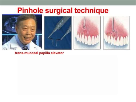 Minimal Invasive Techniques