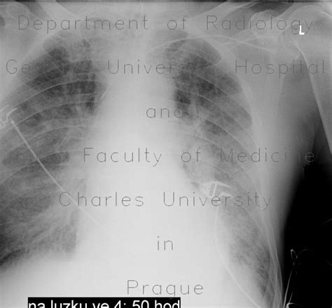 Radiology Case Lung Congestion