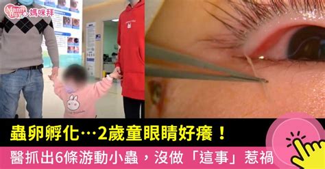 蟲卵孵化2歲童眼睛癢，醫抓出6條2cm游動小蟲，竟是沒做「這事」惹禍｜好雞婆 媽咪拜mamibuy