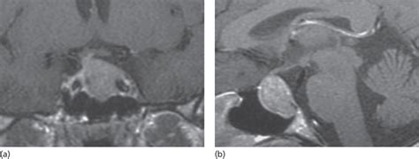 Neoplasms Of The Endocrine Glands Pituitary Neoplasms Oncohema Key