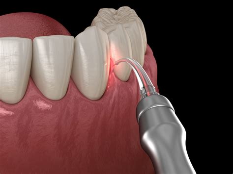 Smile Transformation With Gum Contouring Bellaire Tx