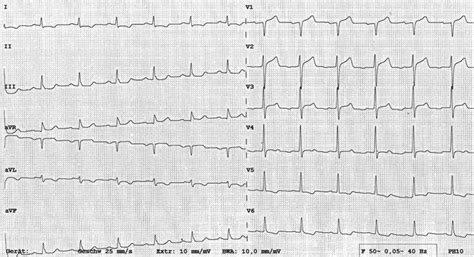 Pseudonormalization Upright T Waves In Leads V2 4 During Angina Pectoris Download Scientific