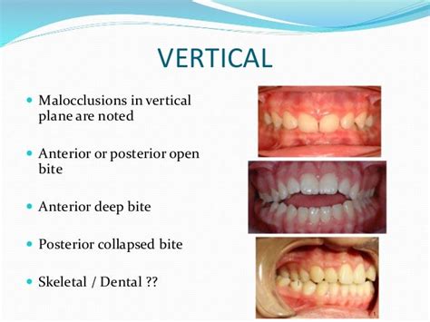 Ackerman And Proffit Classification Of Malocclusion
