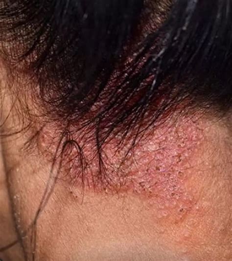 15 Effective Home Remedies For Itchy Scalp Relief