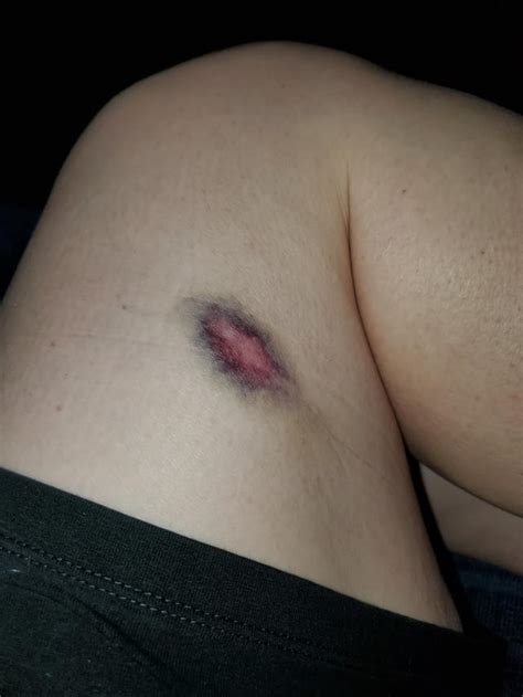 Early Thigh Thursday Submission My Prettiest Bruise From Moving R