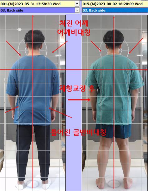 골반교정 척추측만증교정 후기 청라 체형교정 인체균형연구소 네이버 블로그