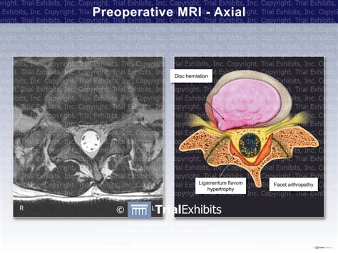Preoperative Mri Axial Trialquest Inc