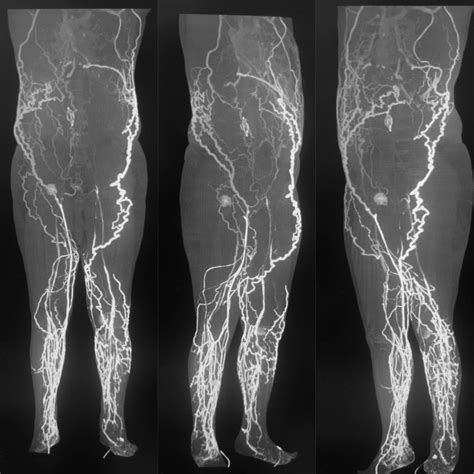 Mo Nabih On Linkedin Anjio Venography Lower Limb 100cm Contrast 2 5 Flow Rate Siemens 128 26