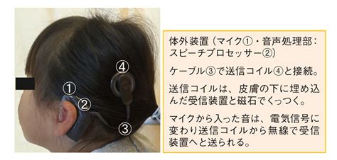 子どもの難聴子どもの難聴って補聴器と人工内耳の違いは あいち小児保健医療総合センター