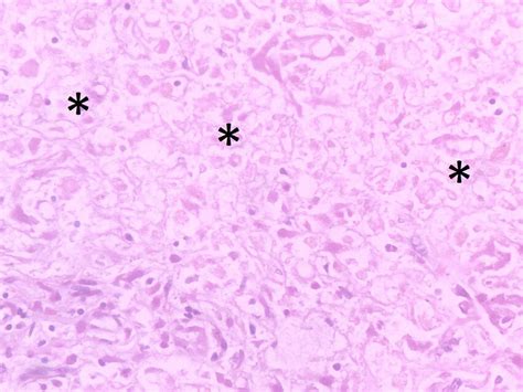 Hepatocyte Necrosis With Feathery Degeneration Hande 400× Download