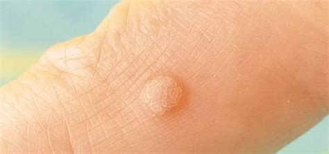 Photo Gallery Of Warts On Different Body Parts