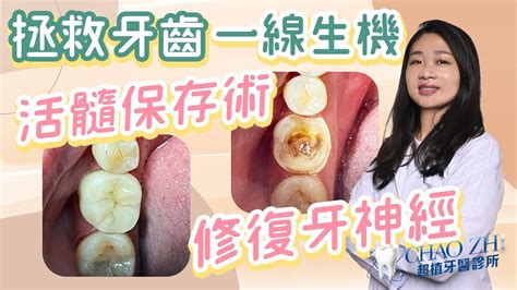 「髓」這麼厲害！｜台中牙科陳怡蓉醫師小學堂 Ep4 有招「活髓保存術」能夠及時將牙神經保護起來 活髓保存術 根管治療 Youtube