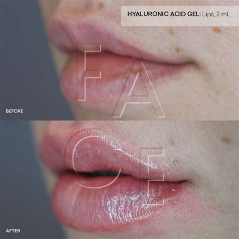 Bump On Upper Lip