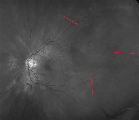 Lesson Choroidal Folds A New Wrinkle In Retinal Care