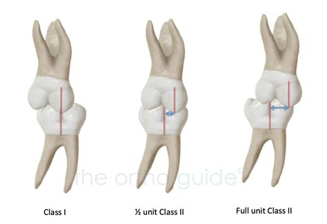 Class Ii Detailed Page 4 The Ortho Guide