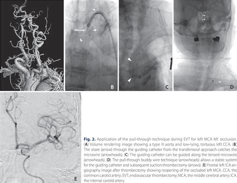 Figure 2 From Pull Through Buddy Wire Technique For Endovascular