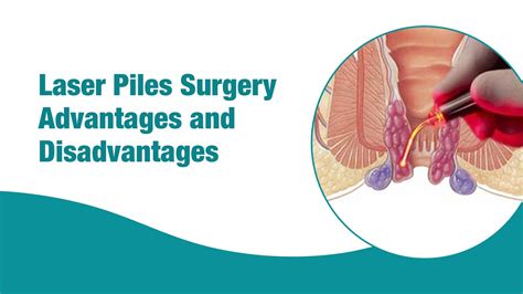 Laser Piles Surgery Advantages And Disadvantages