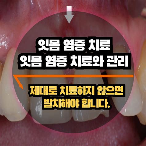 잇몸 염증 제대로 치료하지 않으면 발치해야 할 수도 잇몸 염증 치료와 관리