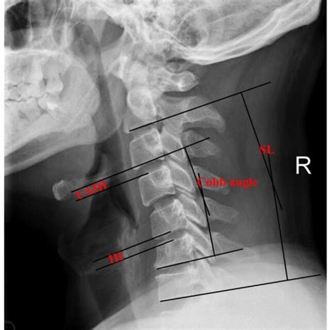 Schematic Representation Of The Radiographic Measurements Cobb Angle
