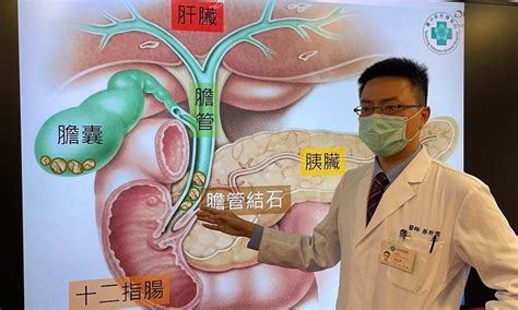 有膽結石一定要開刀嗎？ 最新膽管內視鏡就可擊碎「巨石、頑石」 康健雜誌