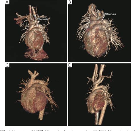 Figure 3 From Surgical Repair Of Persistent Fifth Aortic Arch
