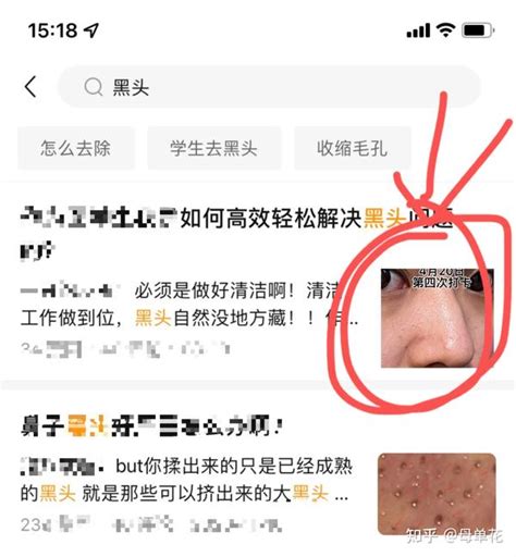 我黑头摸起来一粒一粒的，能挤出来黄黄的条状，用啥能把黑头去掉啊？求推荐 知乎