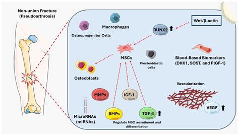 The Genetic And Biological Basis Of Pseudoarthrosis In Fractures