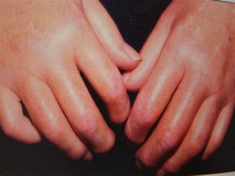 Scleroderma Rheumatology Medbullets Step 2 3