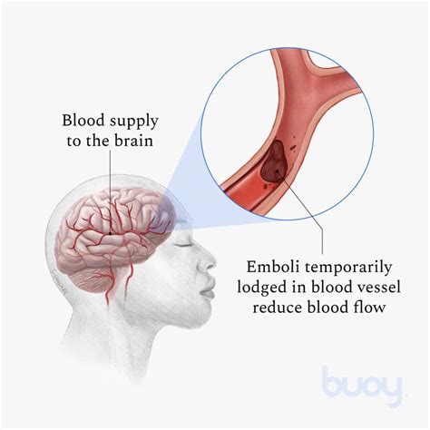 Transient Ischemic Stroke Symptoms