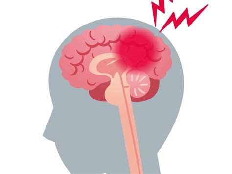 Por Dentro Salud Conoce Los Riesgos De Sufrir Un Derrame Cerebral