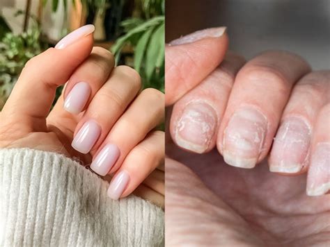 Allergic Reaction Womans Nails Started Peeling Away From Her Nail Bed