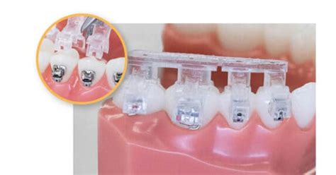 Orthodontic News Ormco Announces The Launch Of Its Latest Innovation
